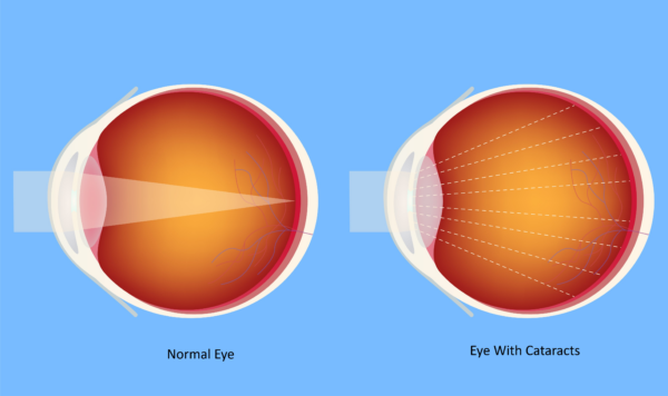 LASIK Surgery in Your 50's and 60's: What You Need to Know - The LASIK ...
